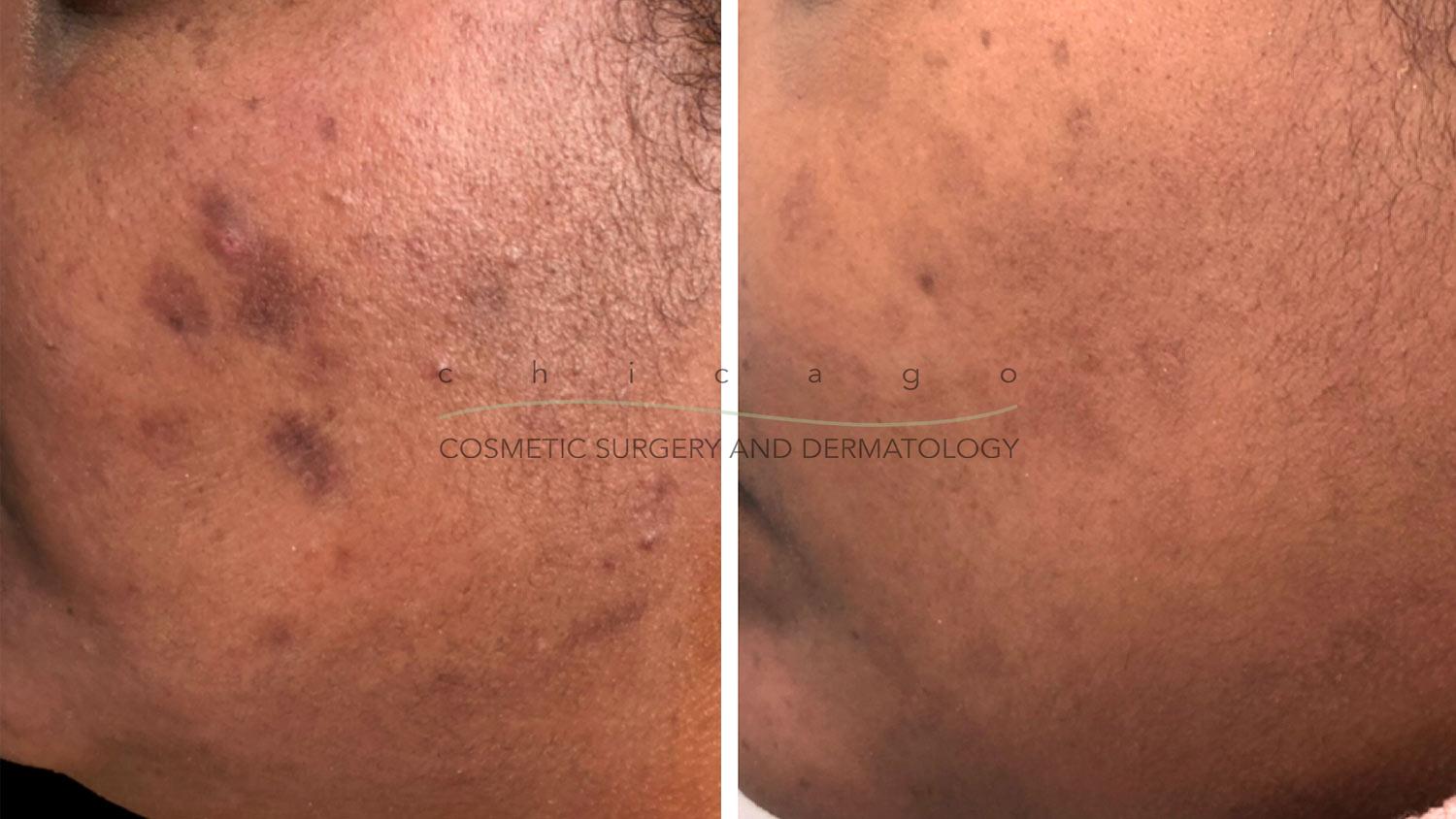 What is Hyperpigmentation And How To Treat It?